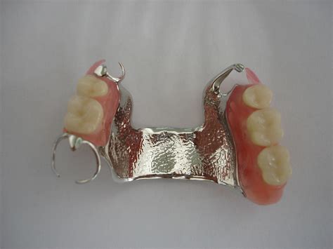 Maxillary Partial Denture Resin Base Cost At Marie Vicente Blog