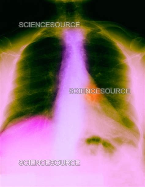 X Ray Of Calcified Hilar Lymph Nodes Stock Image Science Source Images