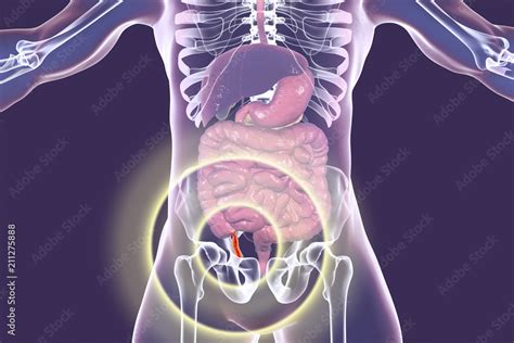 Acute Appendicitis 3d Illustration Showing Inflammed Appendix Inside Human Body Stock