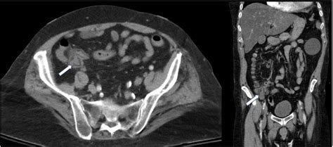 Cecal Mass On Ct Ap White Arrows Download Scientific Diagram
