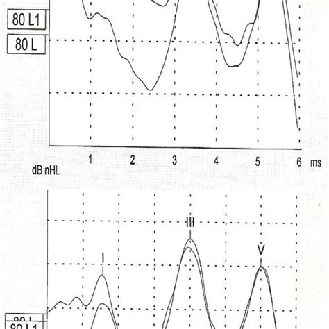 Comparison Of Absolute Latencies And Inter Peak Intervals Of Abr Waves