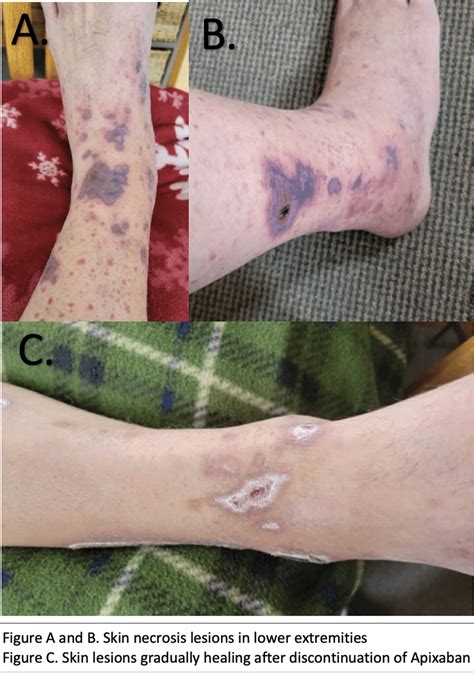 A Case Of Apixaban Induced Skin Necrosis Jacc