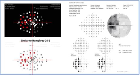 MyVisualFieldStatic Test The Visual Field Test Performed With A Smartphone And A Virtual