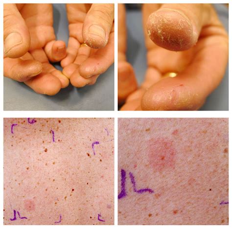 Image Patch Testing In Allergic Contact Dermatitis Merck Manual Professional Edition