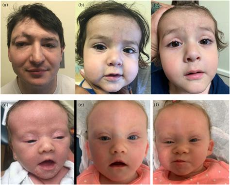 Insights Into The Perinatal Phenotype Of Kabuki Syndrome In Infants