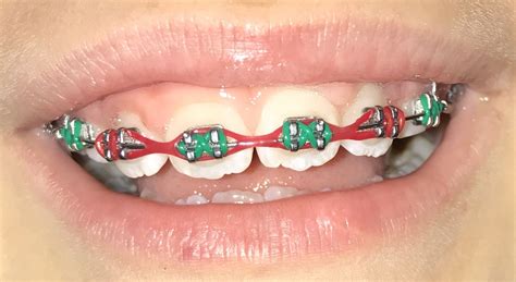 Colorful Braces