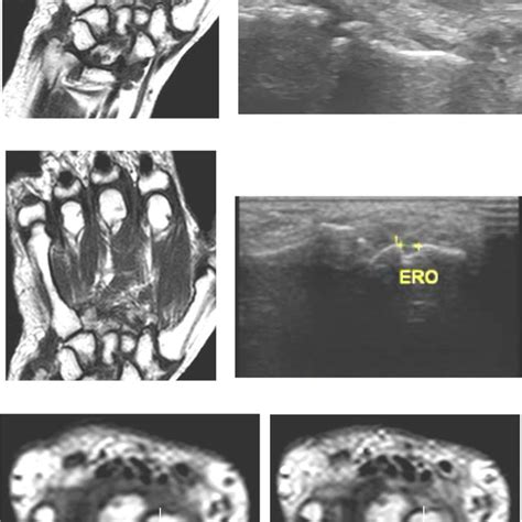 Dorsal Longitudinal Gs Scan Showing Scoring Of The Mcp Joint Synovitis