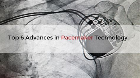 Advances In Pacemaker Technology Modern Heart And Vascular