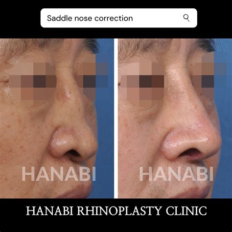 Saddle Nose Deformity And Correction Hanabi Rhinoplasty Clinic