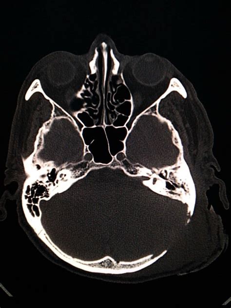 Calvarial Metastasis
