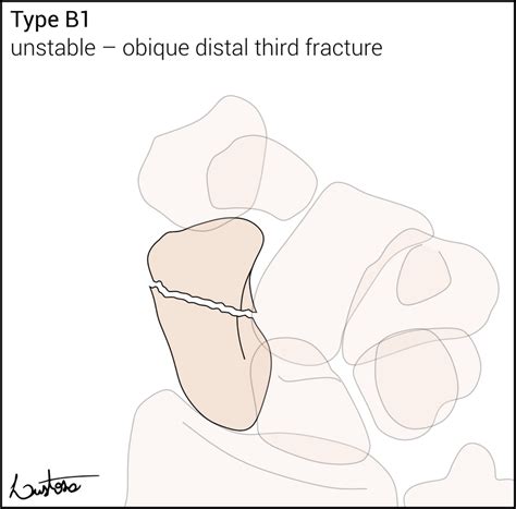 Radiopaedia Case Herbert And Fisher Classification Of Scaphoid