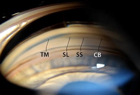 Gonioscopy Procedure Types And Benefits For Eye Health