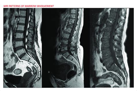 Mri Patterns Of Marrow Involvement In Multiple Myeloma Showing Download Scientific Diagram