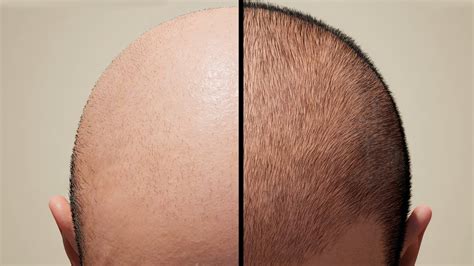 Top 5 Derma Rollers For Hair Growth And Revitalized Scalps Uk 2025