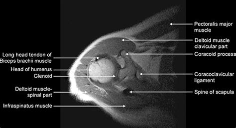 Deltoid Muscle Anatomy Mri