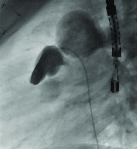 Angiografía Lateral En El Tronco De La Arteria Pulmonar Que Muestra La