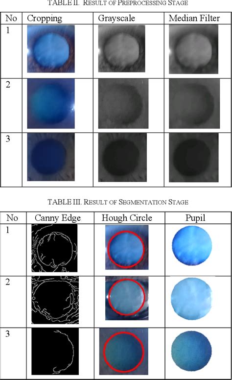 Table Iii From Cataract Detection Using Single Layer Perceptron Based