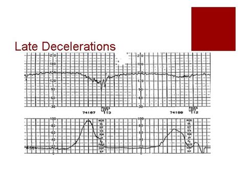Electronic Fetal Heart Rate Monitoring Aka Reading Strips