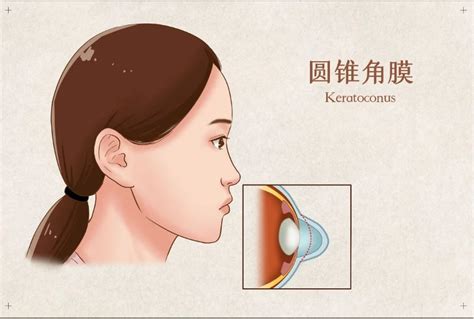 臻祥寿三果眼益：眼睛痒怎么办？ 哔哩哔哩