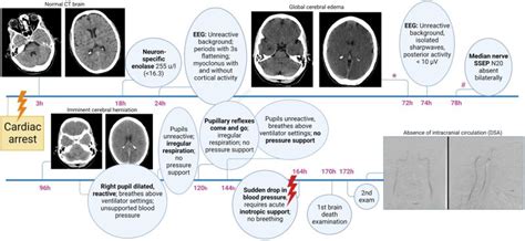 Rob Mac Sweeney On Linkedin Neuroprognostication After Cardiac Arrest What The Cardiologist