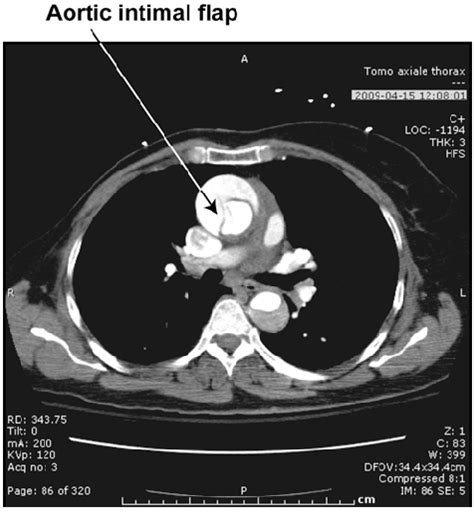 Computed Tomographic Scan Showing The Intimal Flap Diagnostic Of Aortic Download Scientific