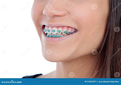 Attractive Young Woman With Brackets Stock Image Image Of Girl