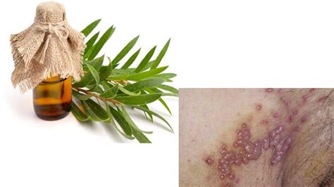 Hpv Amazing 19 Natural Home Remedies