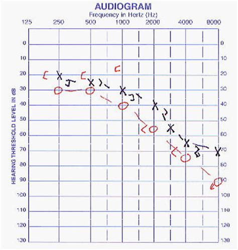 TM Damage By Ear Candling