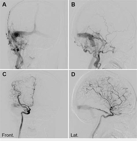 Digital Subtraction Angiogram Dsa Showing Right Sided Download Scientific Diagram
