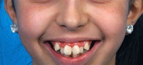 “rosaku I Shëmtuar U Kthye Në Mjellmë” Tv Klan