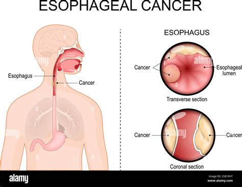 Esophageal Cancer Diagram Esophageal Carcinoma Ppt