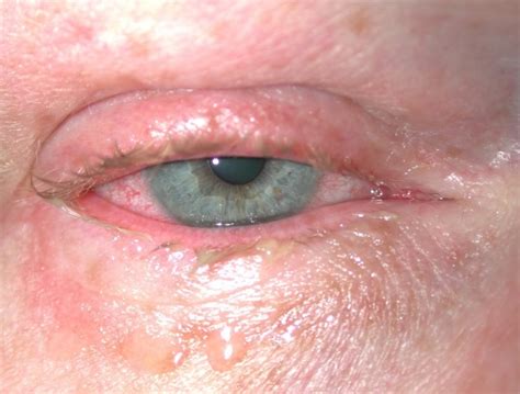 Chronic Allergic Conjunctivitis Download Scientific Diagram