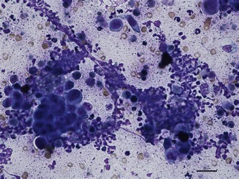 Transitional Cell Carcinoma Cytology