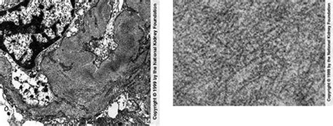 Fibrillary And Immunotactoid Glomerulopathies Genitourinary Disorders