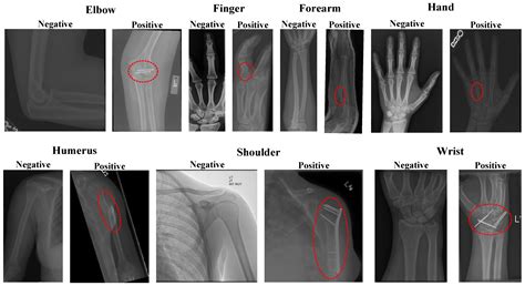 Diagnostics Free Full Text A Pyramid Deep Feature Extraction Model For The Automatic