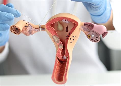 Pedunculated Fibroids My Fibroid Clinic