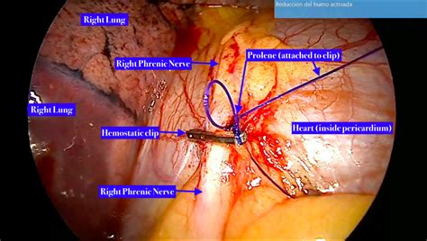 Treating Intractable Hiccups By Clipping The Phrenic Nerve Using Vats Ctsnet