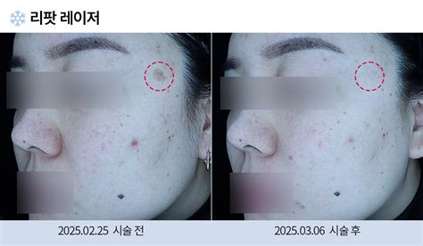 마곡피부과진료 스노우의원 마곡점 마곡보톡스 마곡여드름