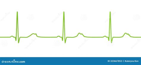 Long Qt Syndrome Ecg 2nd Type 3d Illustration Stock Illustration Illustration Of Calcium