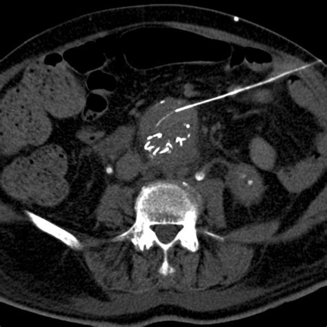 Pdf Ct And Fluoroscopy Guided Percutaneous Transabdominal Embolization Of Type Ii Endoleak