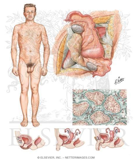Disorders Of Sex Differentiation