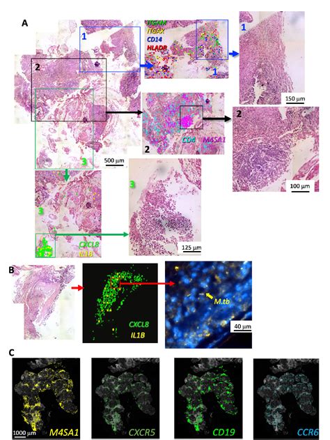 Figure 1 From Immune Mapping Of Human Tuberculosis And Sarcoidosis Lung