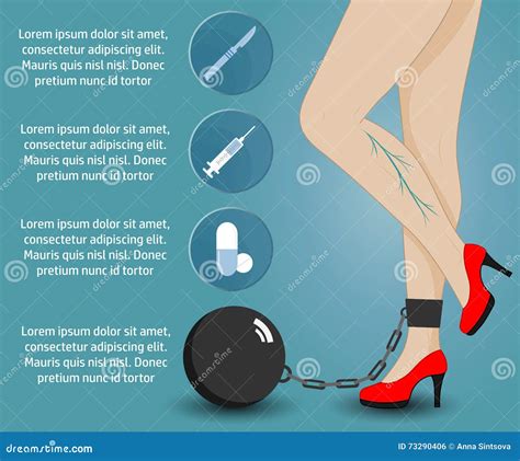 Phlebology Infographic Treating Varicose Veins Vector Illustration Of