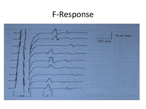 Late Responses F Wave And Hreflex