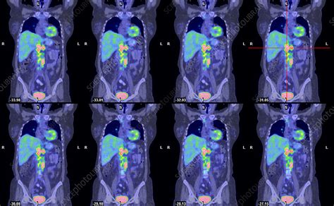 Non Hodgkins Lymphoma Ct And Pet Scans Stock Image M1340687 Science Photo Library