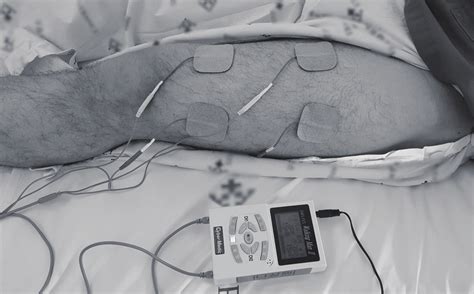 Functional Electrical Stimulation For 20 Minutes Biphasic Symmetrical