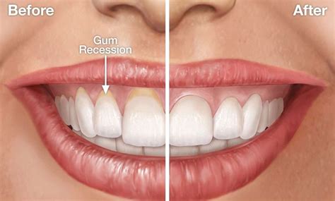 Do You Have Receding Gums