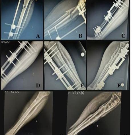 A B External Fixation For Compound Tibia Fracture C D LRS Fixation Download Scientific