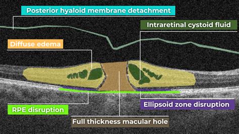 OCT Scan Normal Eye Vs Most Common Pathologies