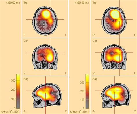 Distributed Source Analysis Results For An Individual Epochs For The Download Scientific